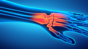 Tfcc Läsion / SL-Bandruptur | Zentrum für Handchirurgie Nürnberg ...