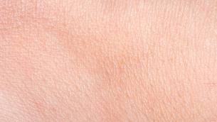 Dermatologische Erkrankungen, Haut Erkrankungen