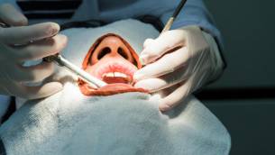 Die häufigsten Fragen und Antworten zur Zahnentfernung