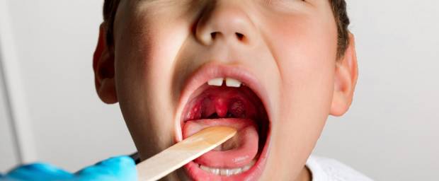 Worin unterscheiden sich Tonsillektomie und Tonsillotomie?