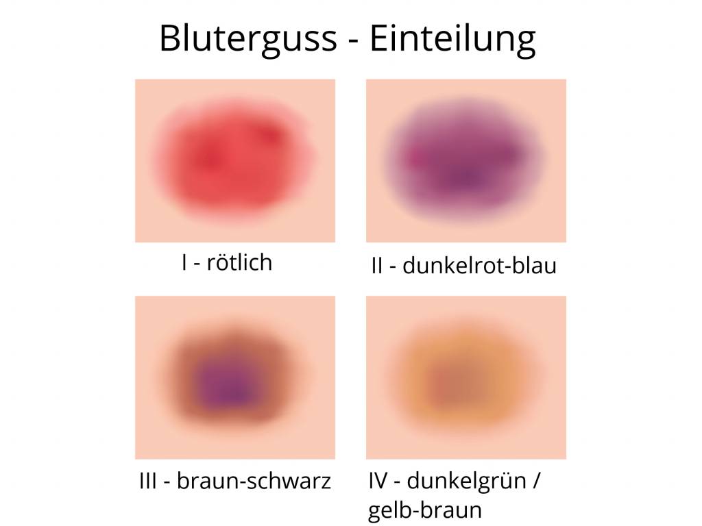 Bluterguss (Hämatom) » So läuft die Operation ab Bluterguss (Hämatom) » So läuft die Operation ab
