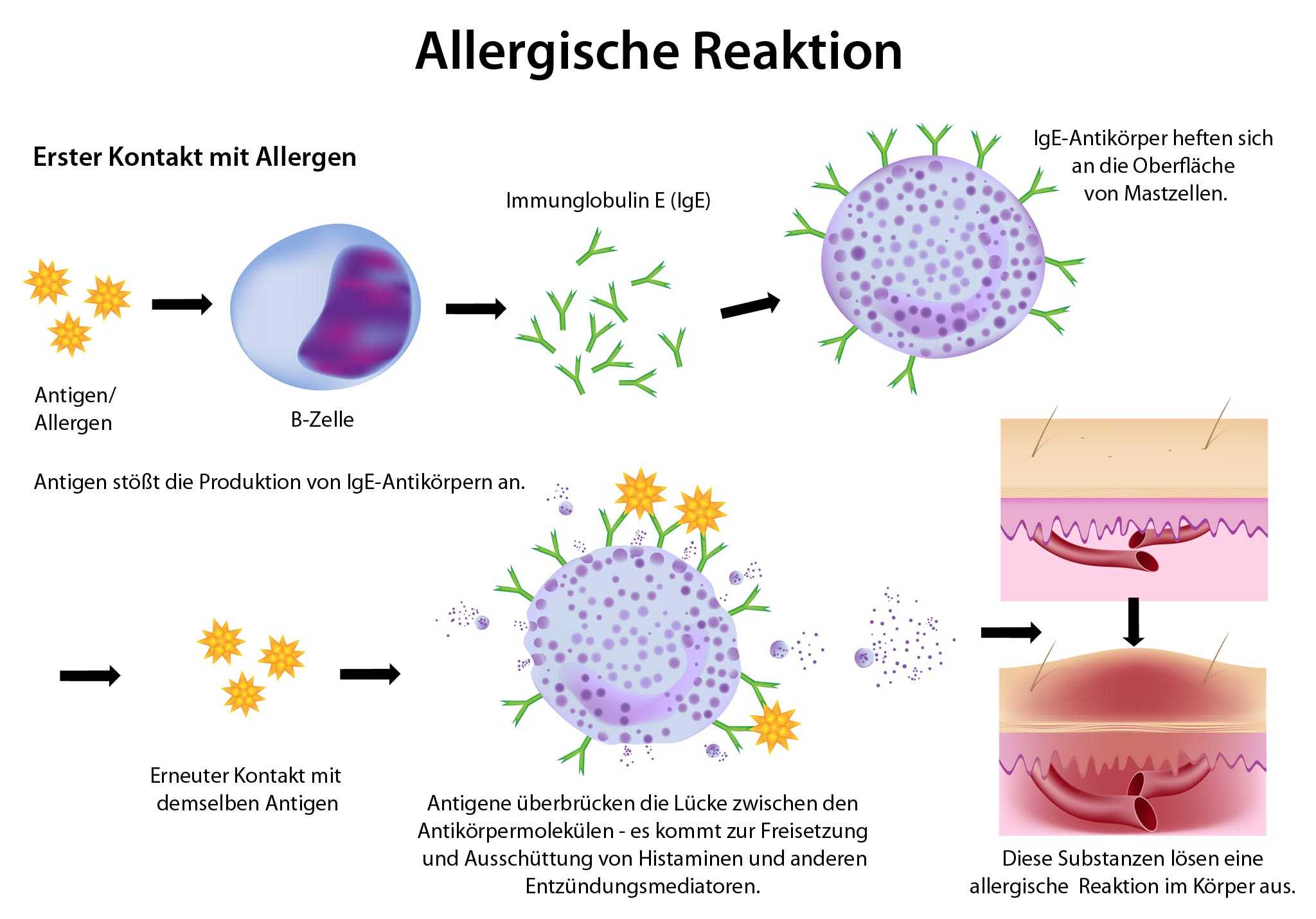 Quaddeln Und Kntchen Am Unterarm Nach Eine Allergische Reaktion Auf Quaddeln Und Kntchen Am Unterarm Nach Eine Allergische Reaktion Auf
