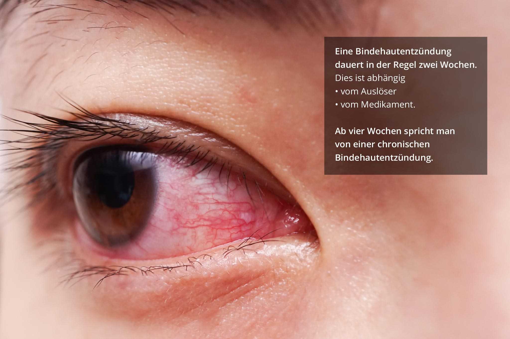 Wie lange dauert eine Bindehautentzündung? Wie lange dauert eine Bindehautentzündung?