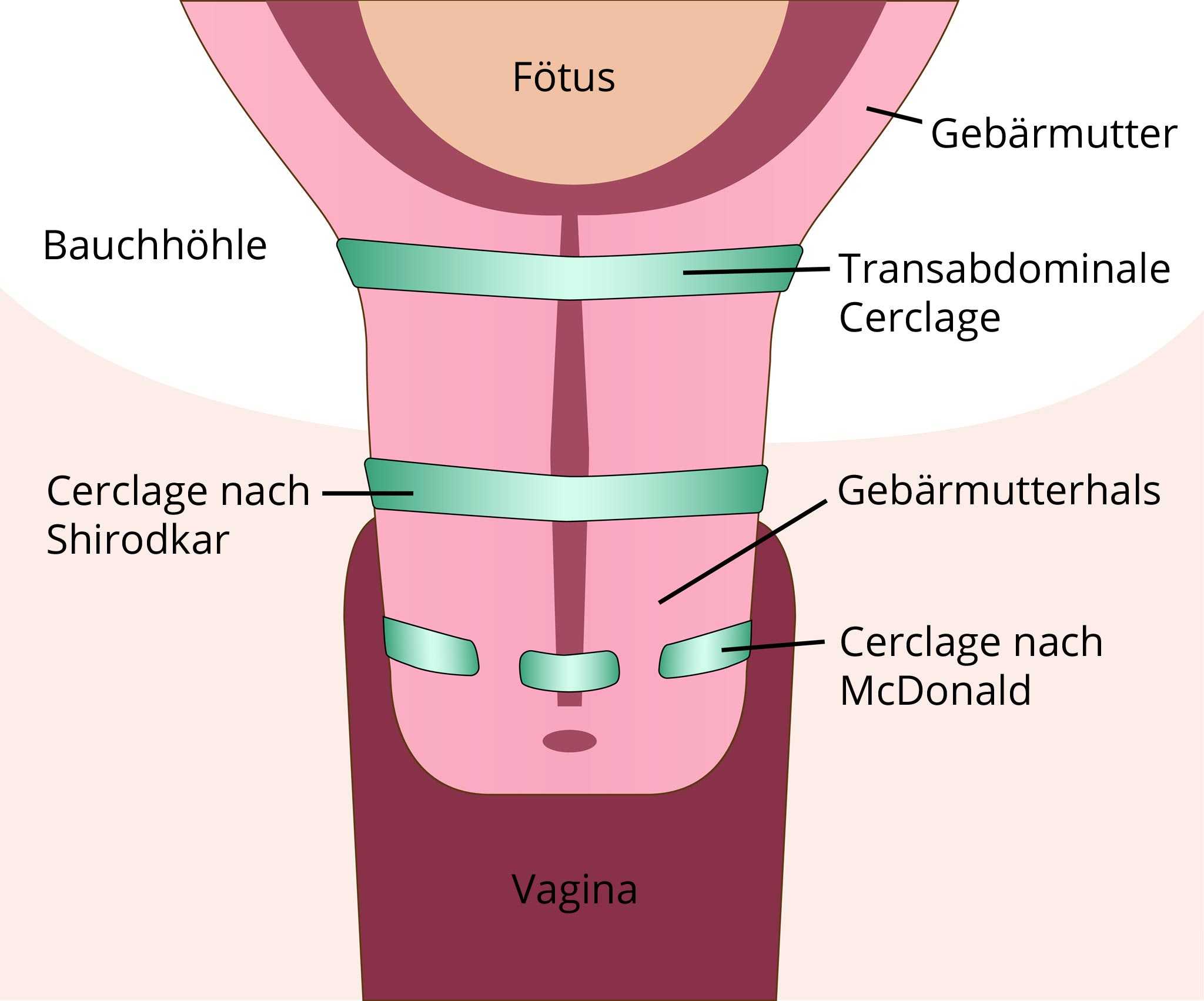 Was ist eine Cerclage nach McDonald?