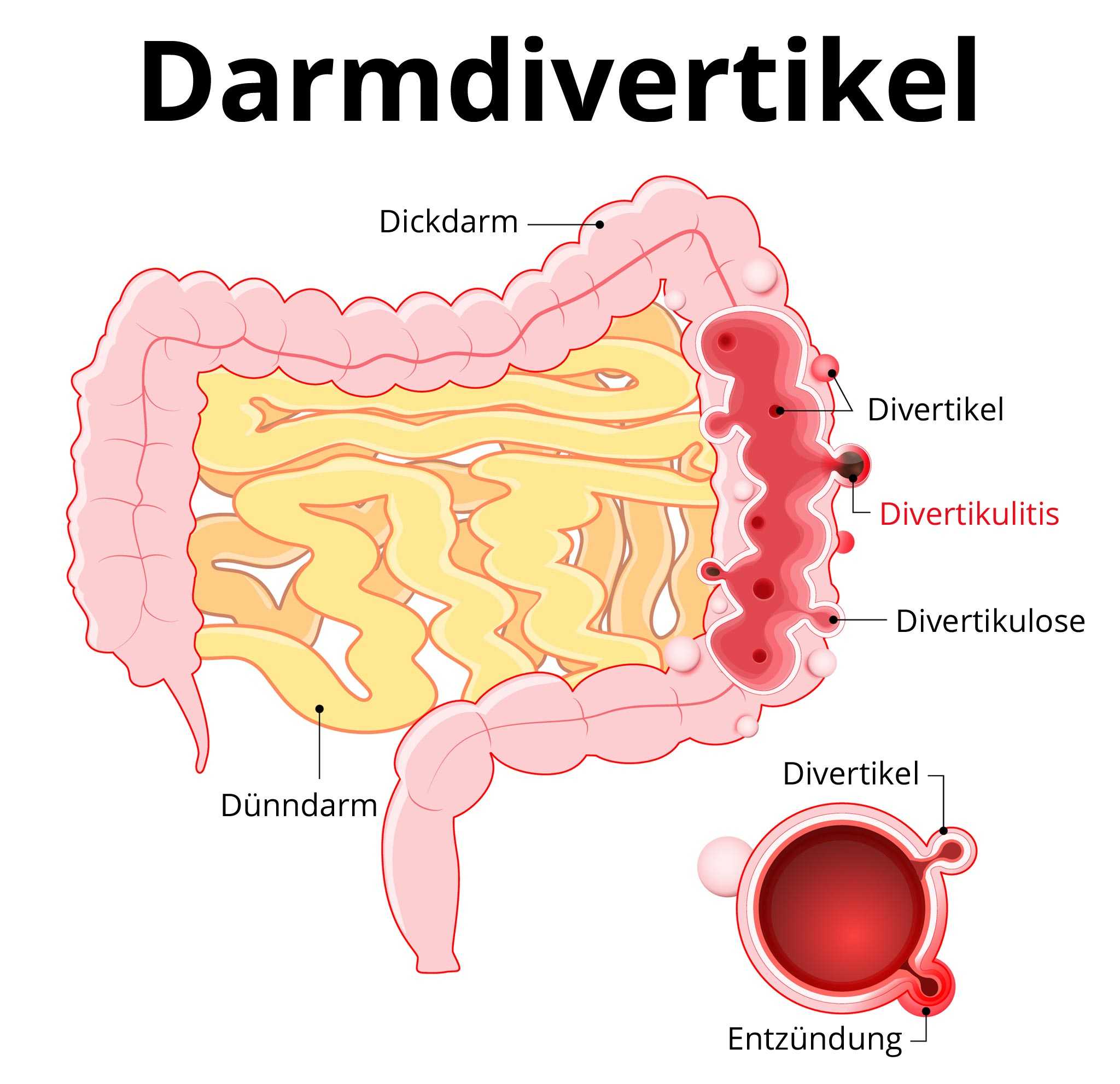 Ursachen Einer Divertikulitis Divertikulitis Ursachen Symptome Ursachen Einer Divertikulitis Divertikulitis Ursachen Symptome