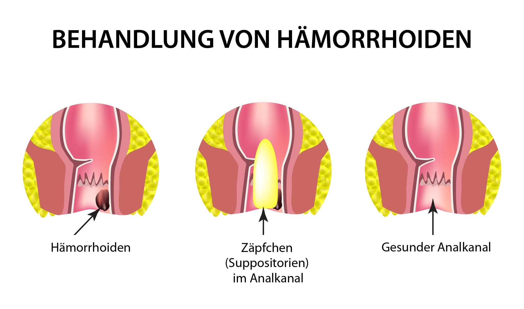 H morrhoiden K hlen Oder W rmen CQVLM H morrhoiden K hlen Oder W rmen CQVLM