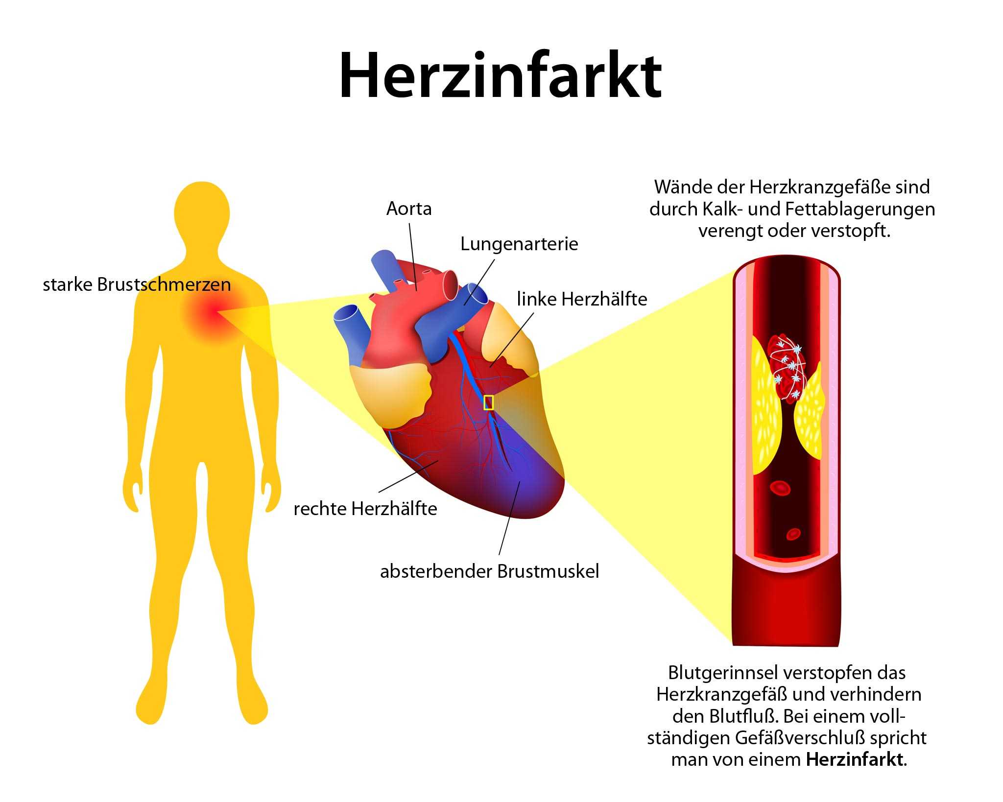 Herzinfarkt Myokardinfarkt Ursachen Und Therapie | My XXX Hot Girl Herzinfarkt Myokardinfarkt Ursachen Und Therapie | My XXX Hot Girl