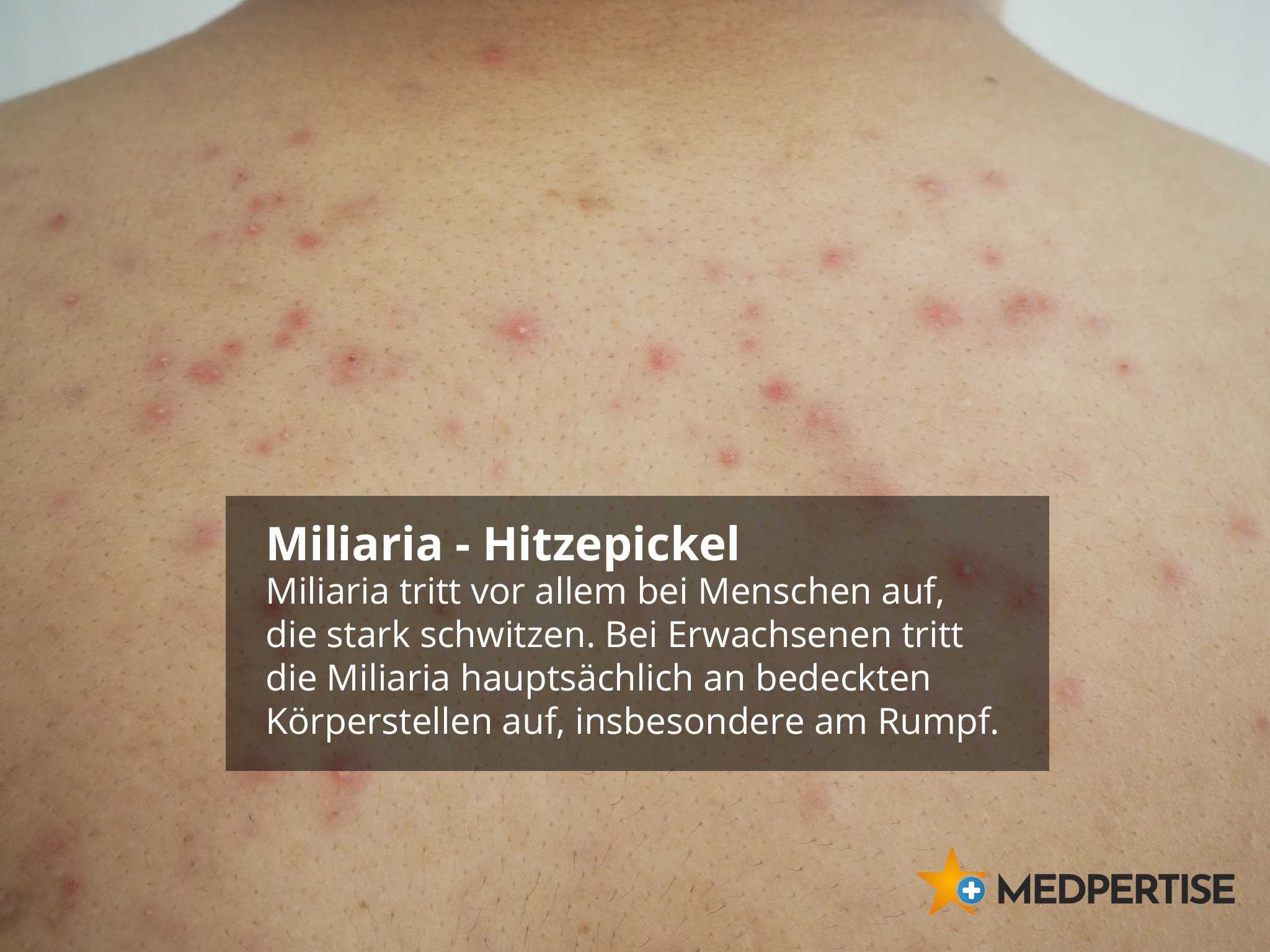 Miliaria Hitzepickel Ursachen Symptome Behandlung Miliaria Hitzepickel Ursachen Symptome Behandlung