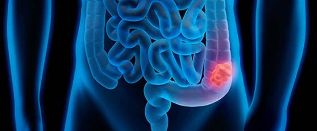 Darmpolypen: Symptome oft erst im fortgeschrittenen Stadium