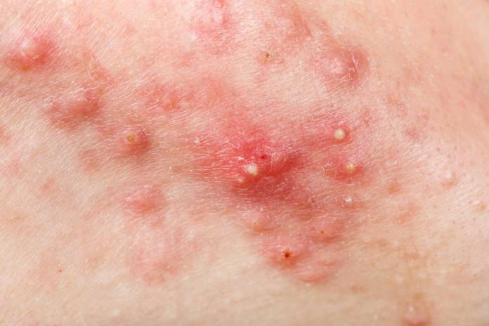 Akne » Formen, Ursachen, Behandlungsmethoden Akne » Formen, Ursachen, Behandlungsmethoden