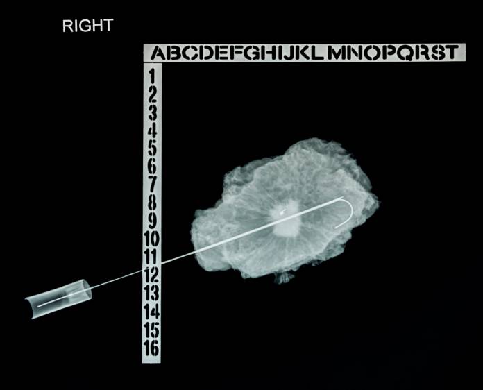 Brustbiopsie, Stanzbiopsie, Vakuumbiopsie, Mamma-Biopsie, Gewebeprobe Brust