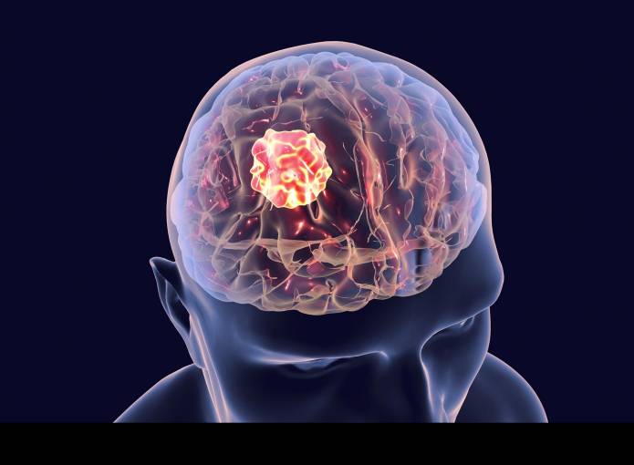 Gehirntumor » Ursachen, Symptome, Behandlung, Prognose