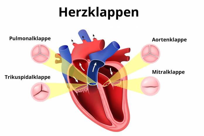 Herzklappenstenose Ursachen Symptome Behandlung
