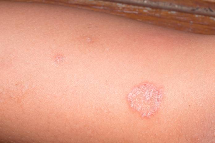 Impetigo contagiosa (Borkenflechte, Grindflechte)