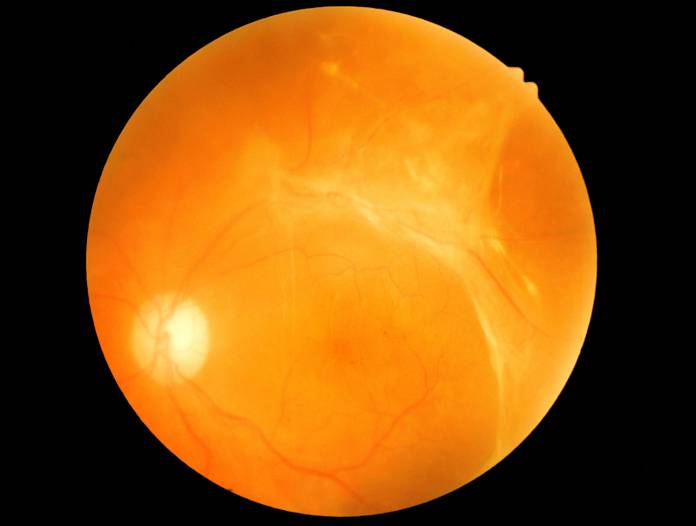 Netzhautablösung, Ablatio oder Amotio retinae, Ablösung der Netzhaut am ...