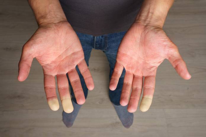 Raynaud-Syndrom » Ursachen, Symptome, Therapie, Prognose
