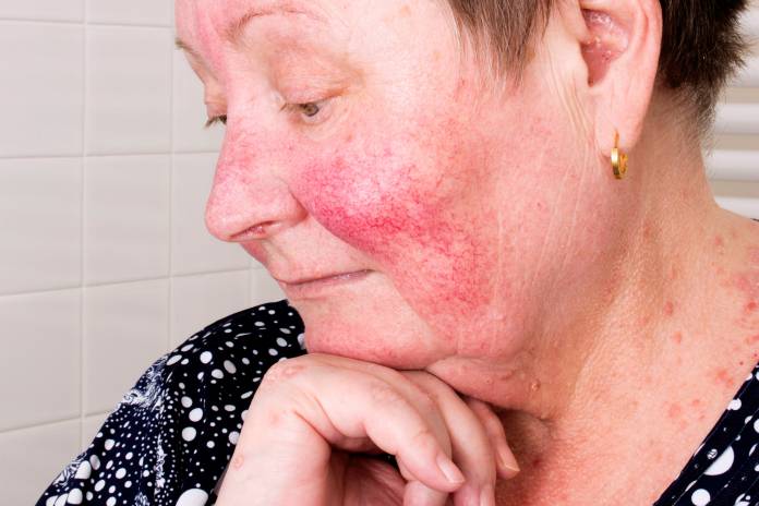 Rosazea » Ursachen, Symptome, Behandlung & Prognose