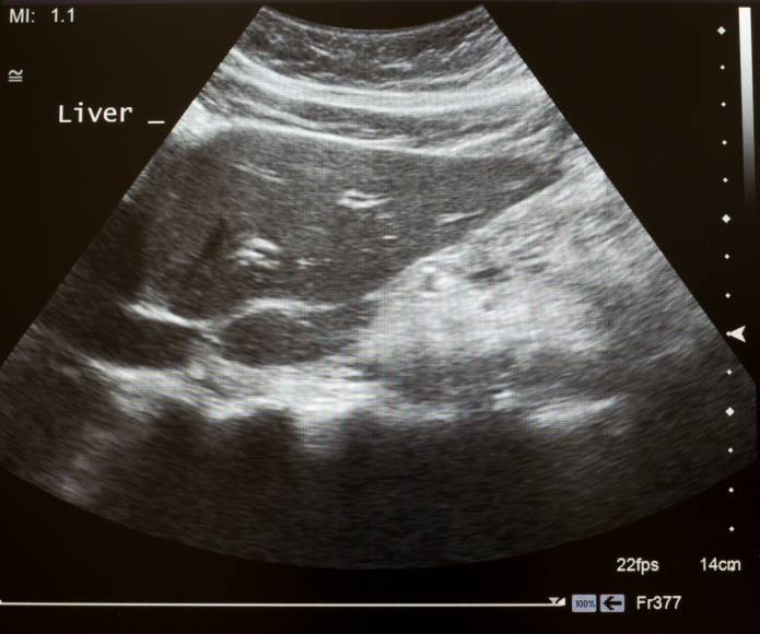 Leberzirrhose » Ursachen, Symptome, Behandlung